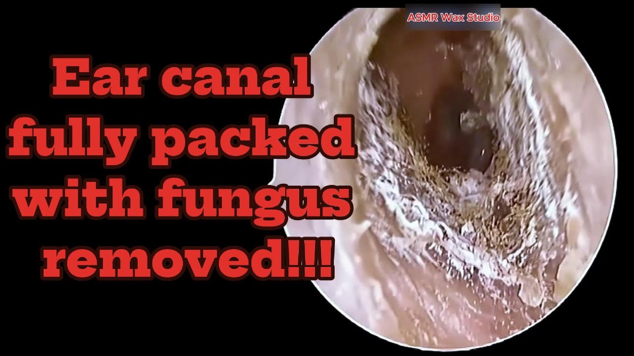 Ear canal fully packed with fungus removed | ASMR clean | relax ...