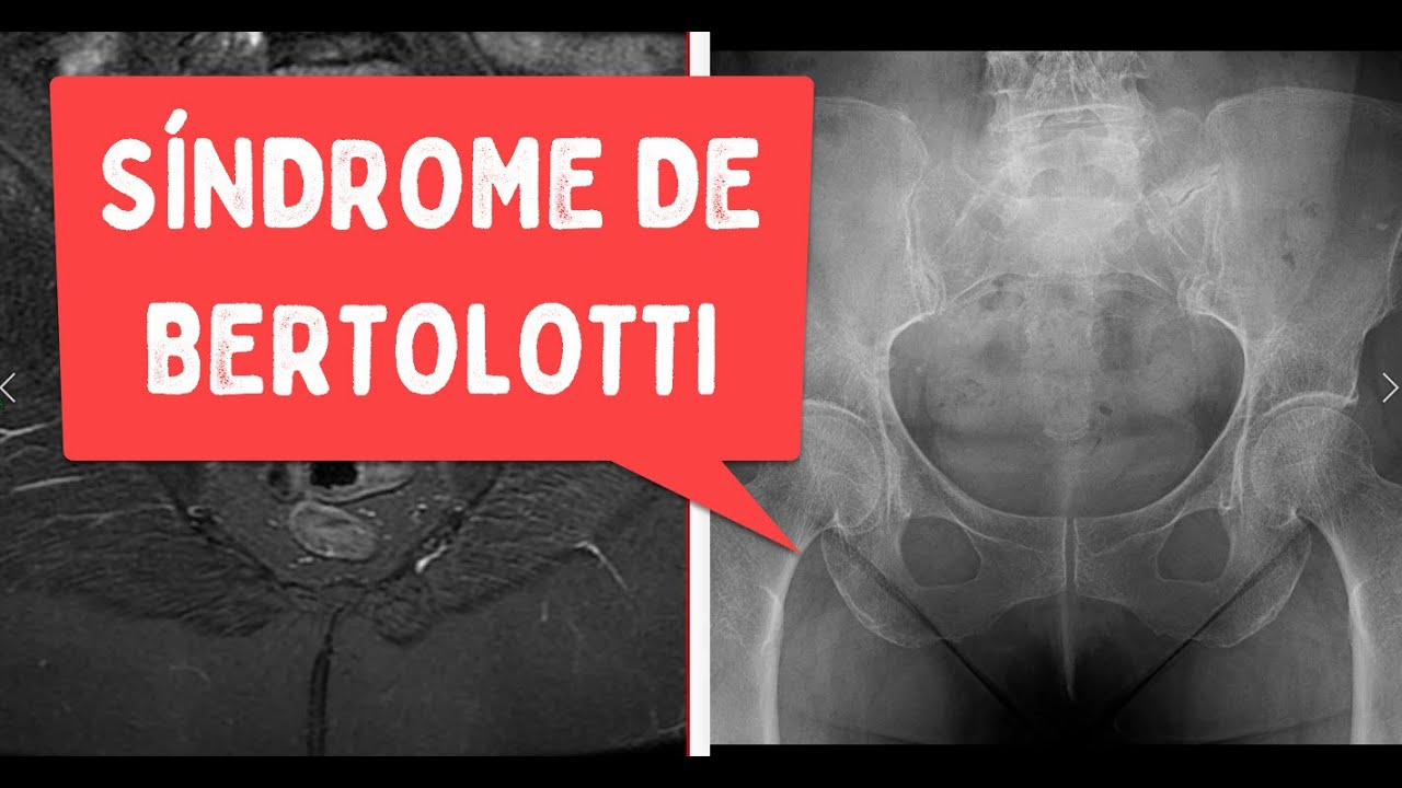 Síndrome de Bertolotti - YouTube
