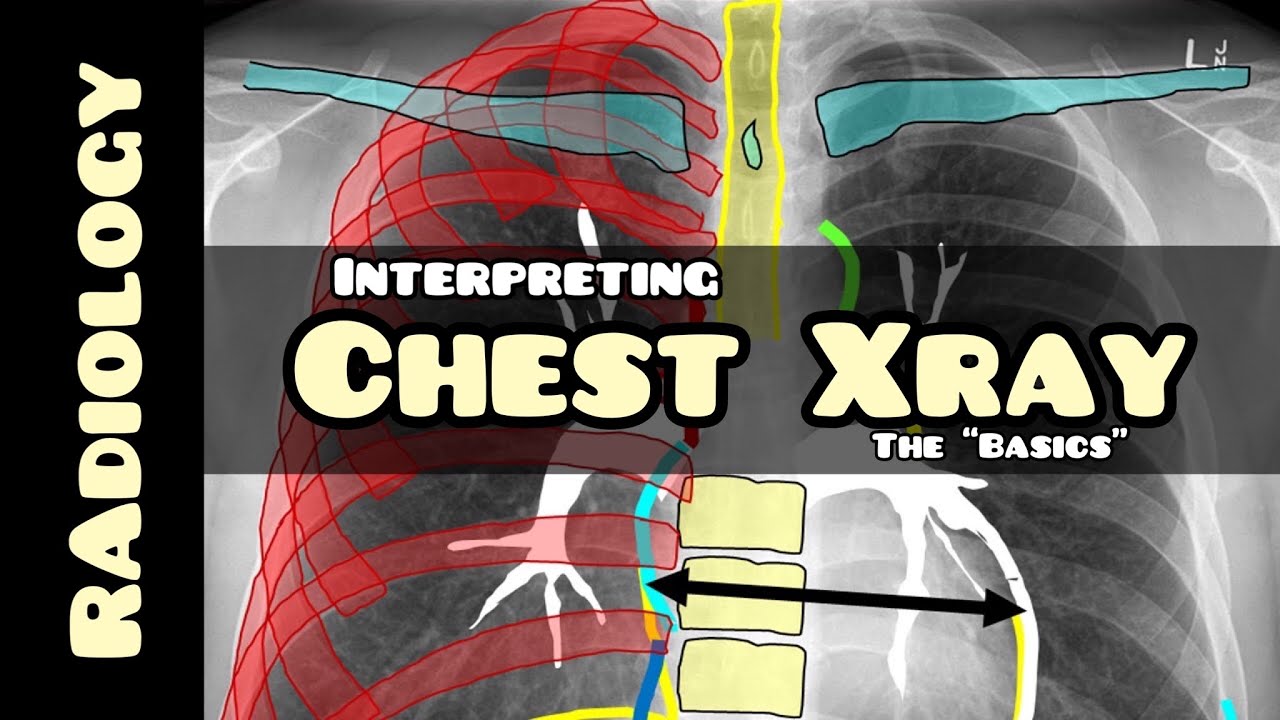 Reading a chest X-ray | Radiology - YouTube