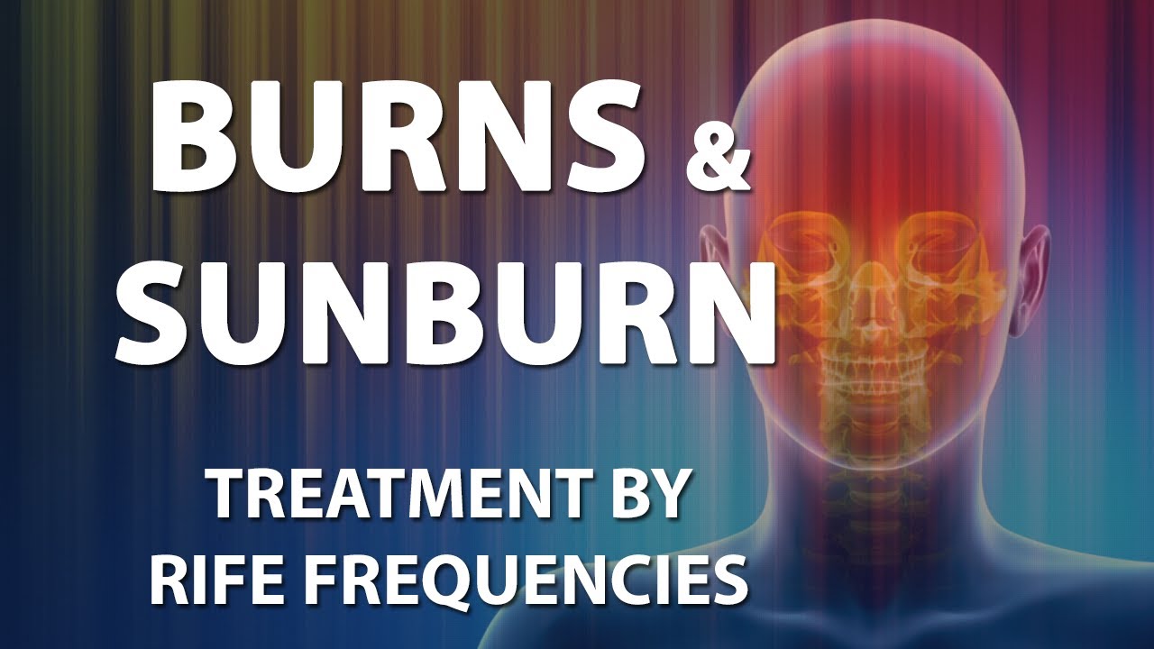 Burns & Sunburn - RIFE Frequencies Treatment - Energy & Quantum ...