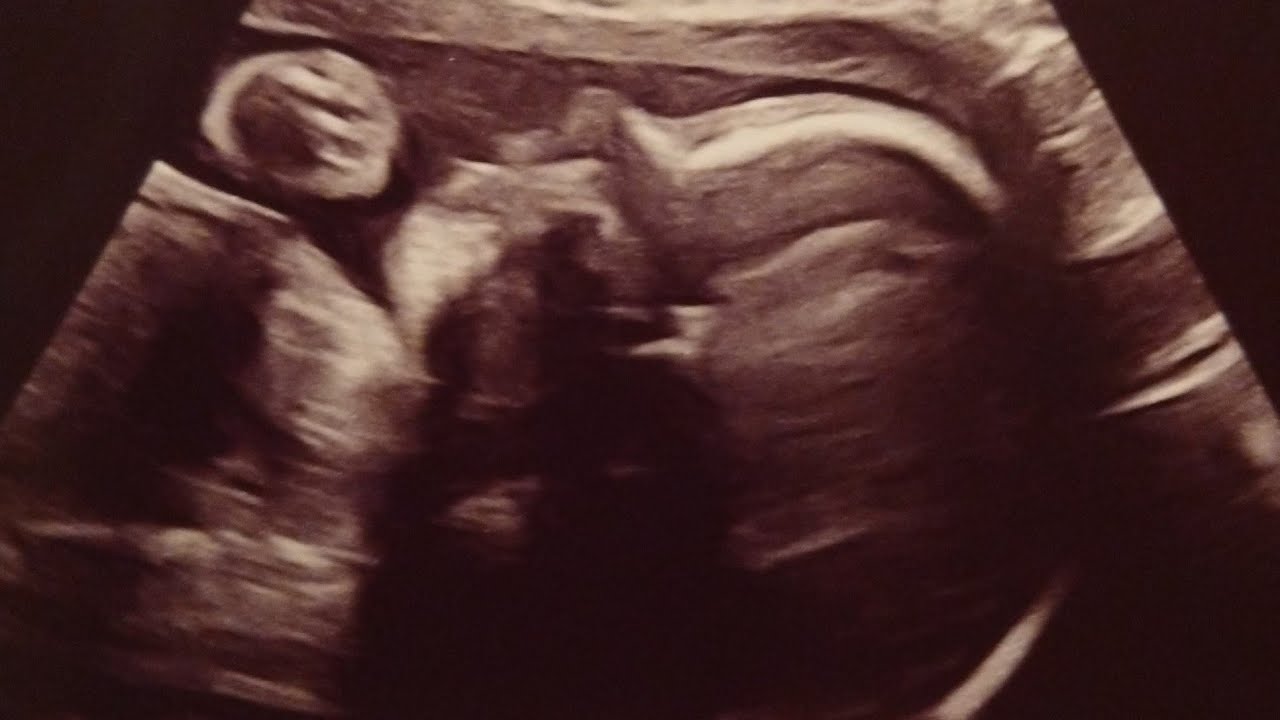 Hyperemesis Gravidarum (HG) in pregnancy, And how to support your ...
