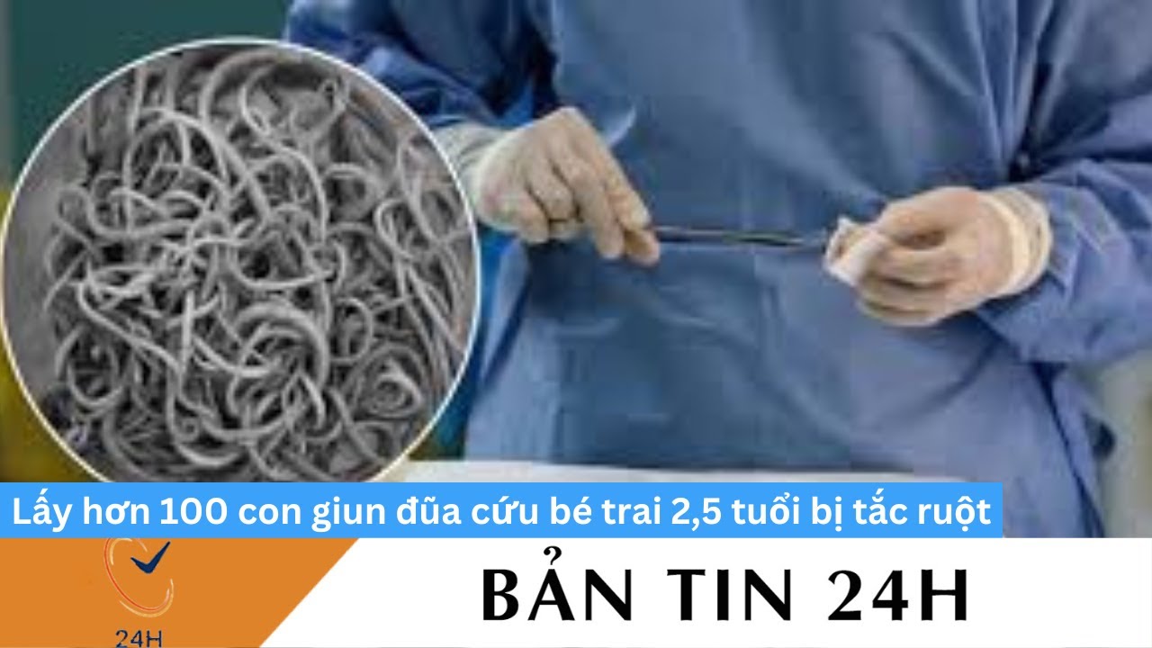 Lấy hơn 100 con giun đũa cứu bé trai 2,5 tuổi bị tắc ruột - YouTube
