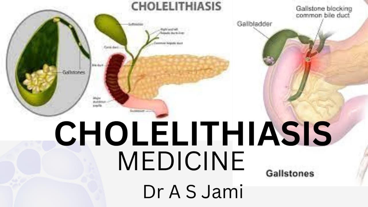 Cholelithiasis Gall Bladder Stones Medicine Lecture English Youtube