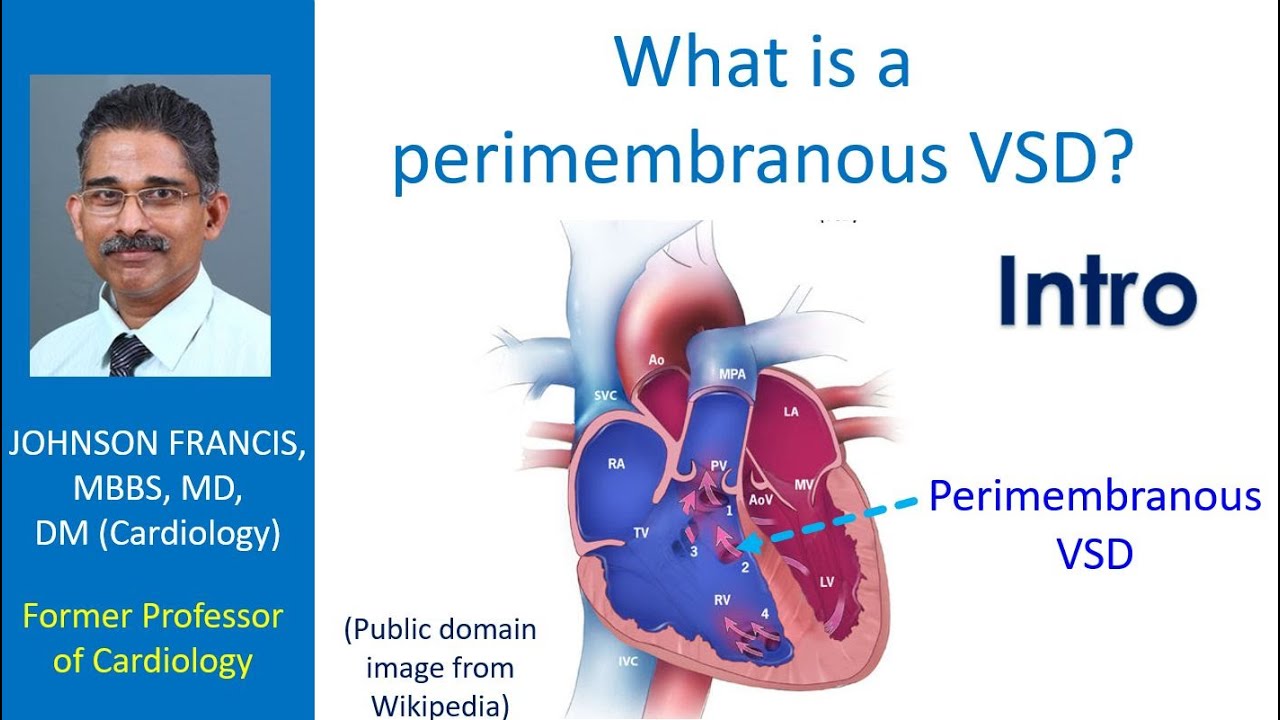 What is a perimembranous VSD? Intro - YouTube