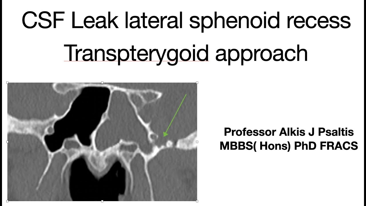 Transpterygoid Approach lateral CSF leak repair Prof Alkis Psaltis ...