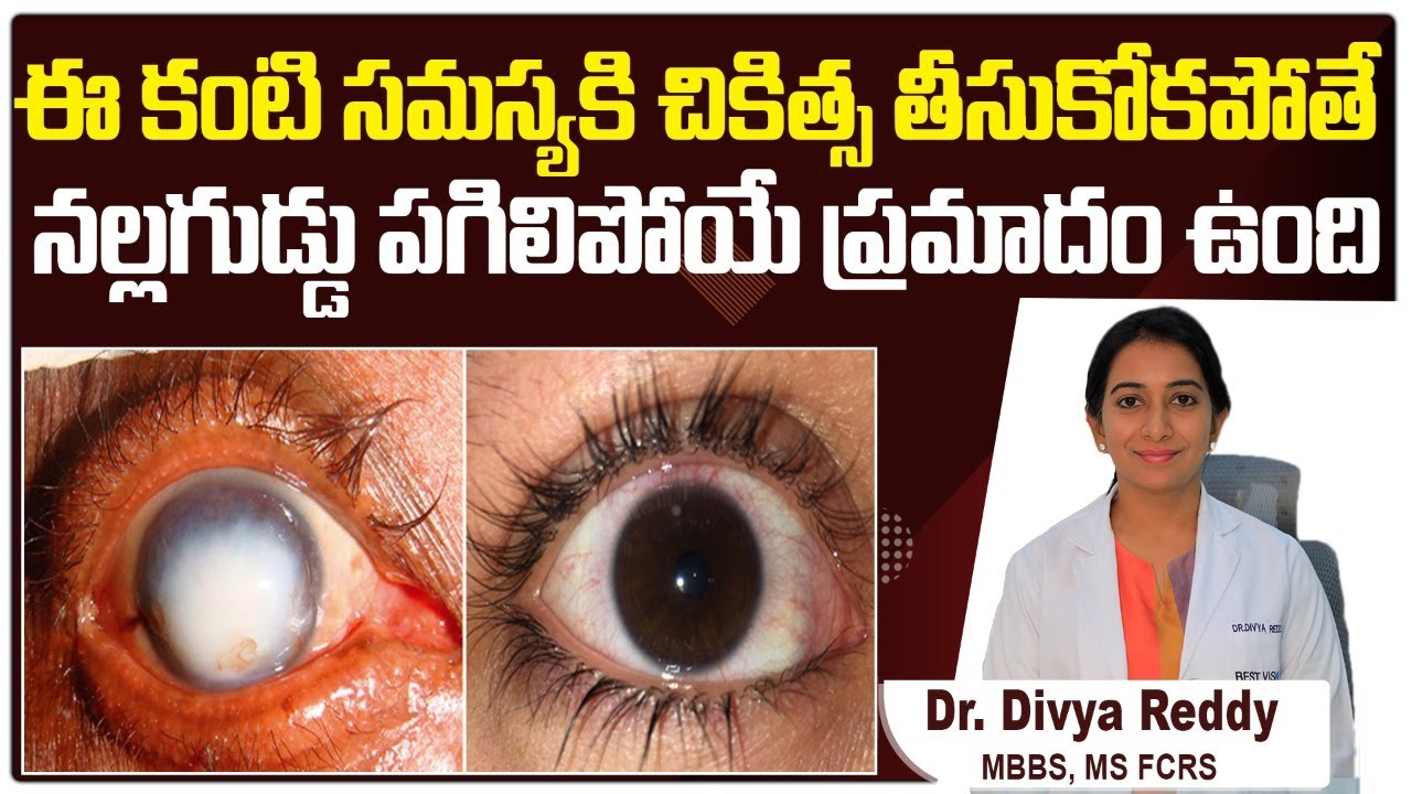 ఈ కంటి సమస్యకి || Keratoconus and C3R Corneal Cross-Linking Treatment ...