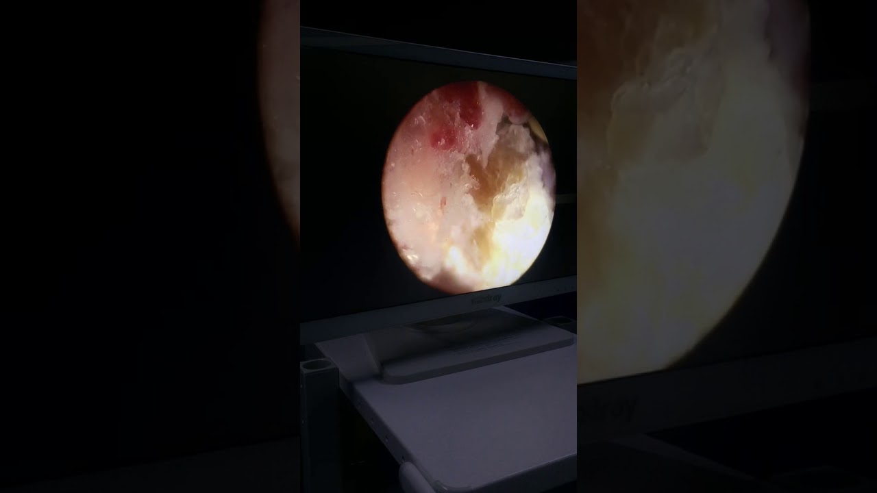 Left kidney stone ( Staghorn calculus ) - YouTube