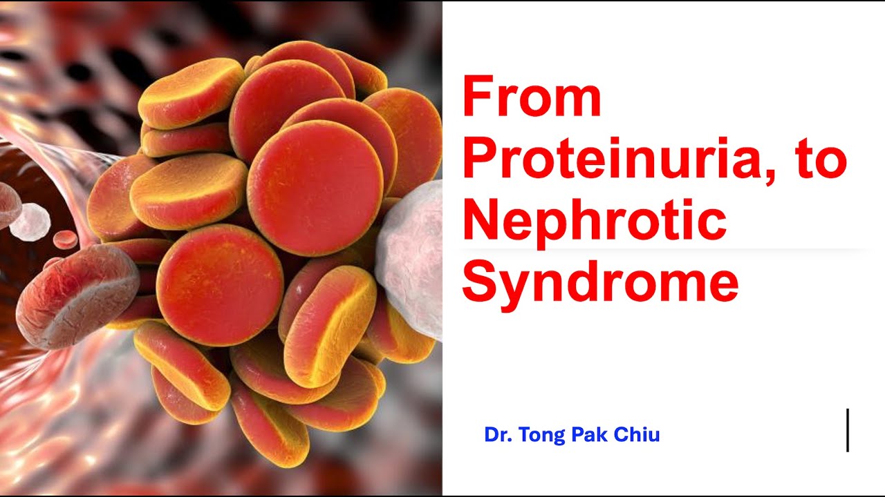 [by Request] From Proteinuria to Nephrotic Syndrome by Dr Tong Pak Chiu ...