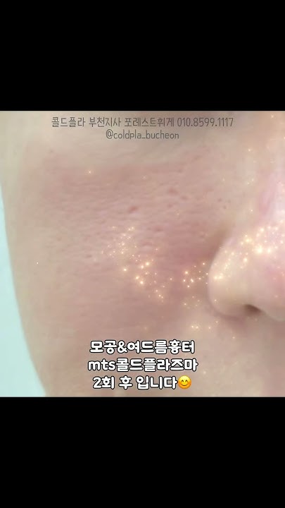콜드플라 콜드플라즈마 콜드mts 피부관리 부천피부관리 Mts관리 Mts피부관리 Mts효과 모공개선 모공관리 모공수축 여드름흉터 포레스트휘게 Youtube