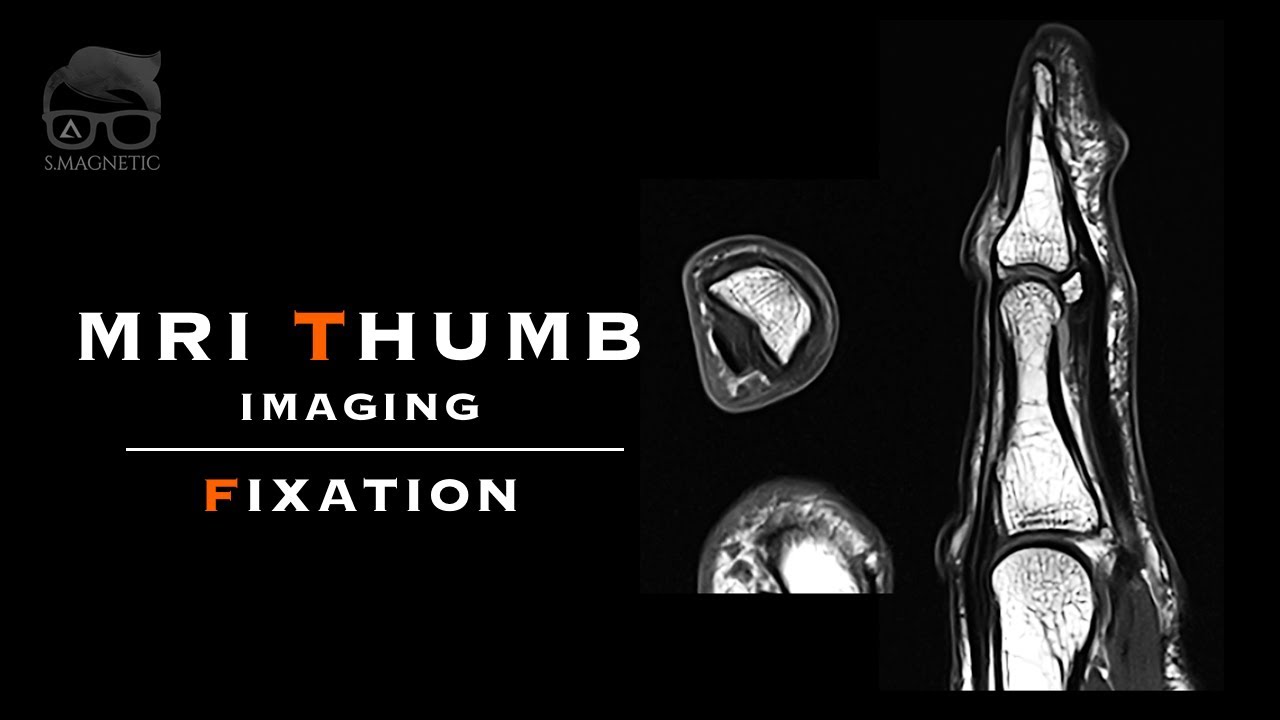 MRI THUMB IMAGING - FIXATION - YouTube