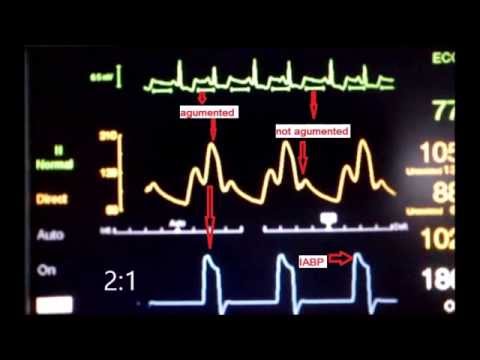 Intra aortic balloon pump - YouTube