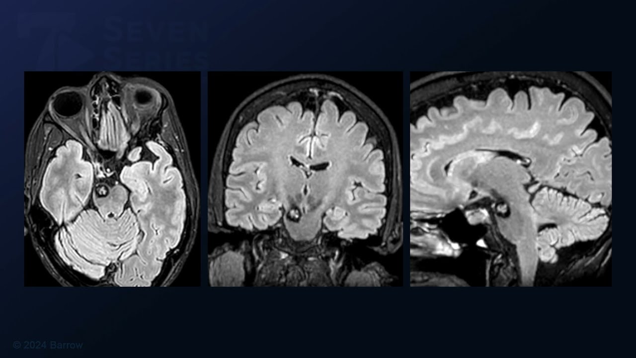 Orbitozygomatic & Transsylvian Approach for Resection of Peduncular ...