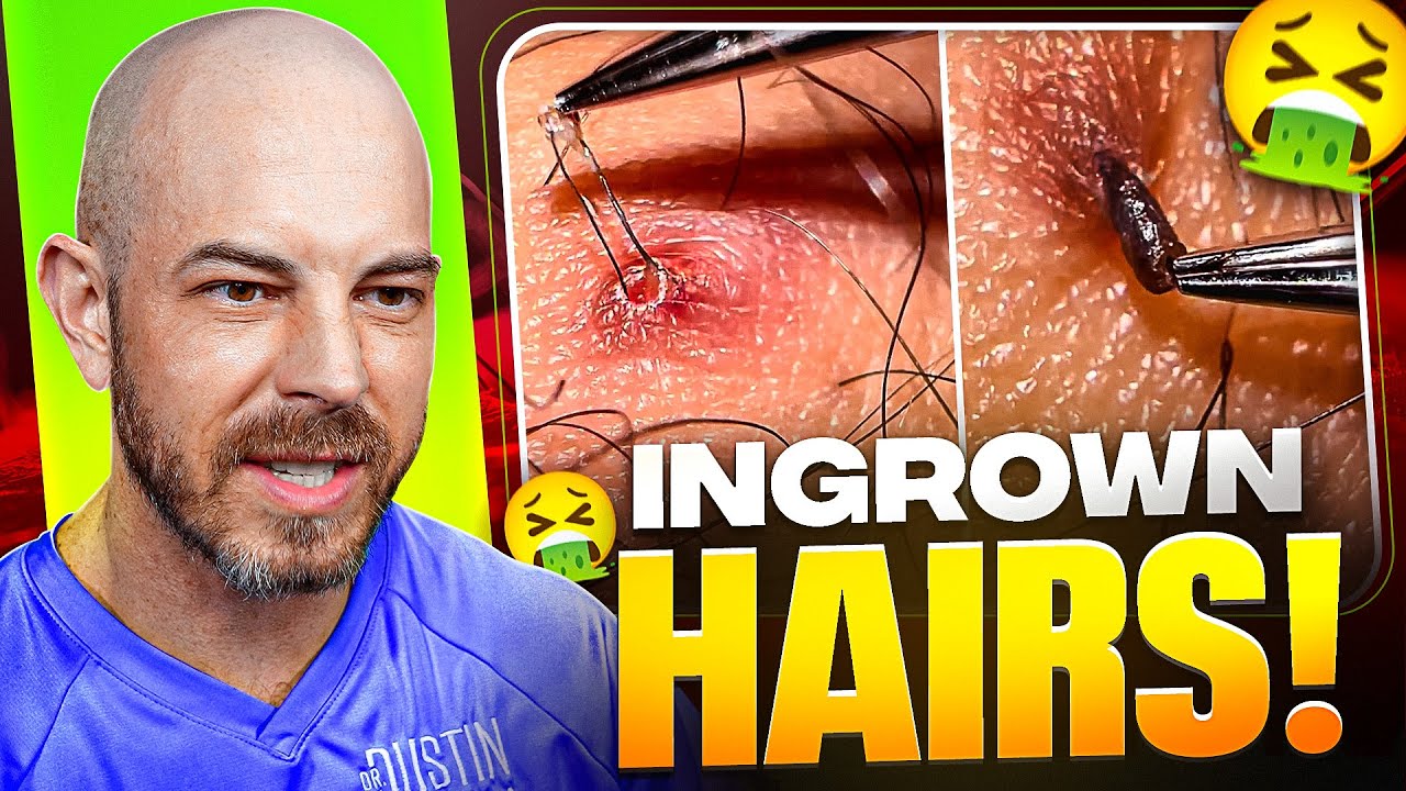 The Truth About Ingrown Hairs | Doctor Explains Causes & Fixes - YouTube