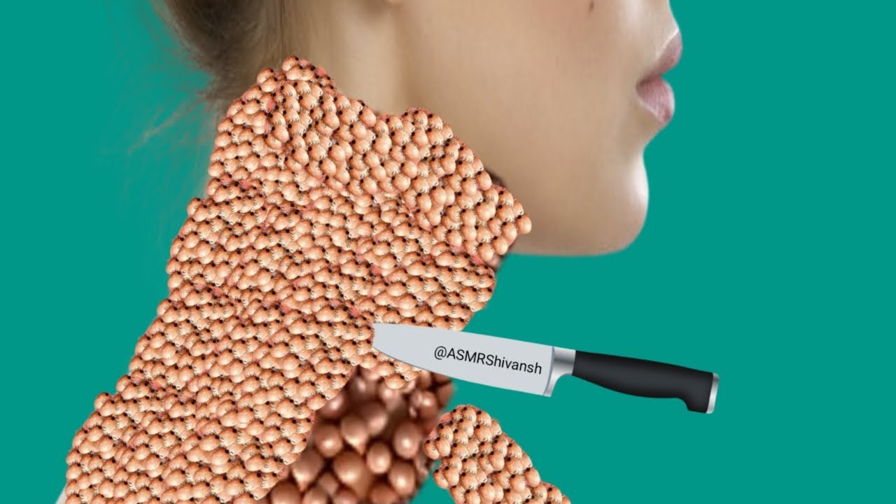 ASMR Big Flakes Dandruff & Head Lice Removal | Satisfying Scalp ...