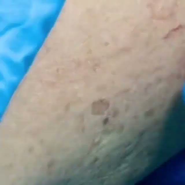 VeinGogh Treatment - YouTube