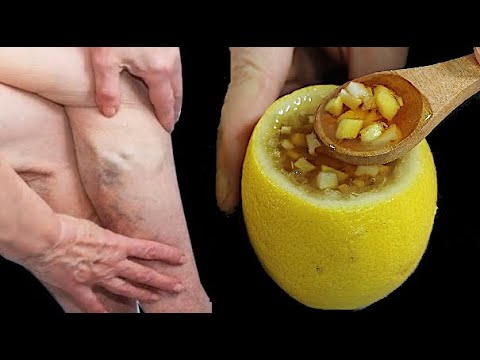 Bacak Ağrısı, romatizma, varisli damarlar kramplarını artriti, Baş ağrısı, Eklem AĞRISI. Bu bitki. 3