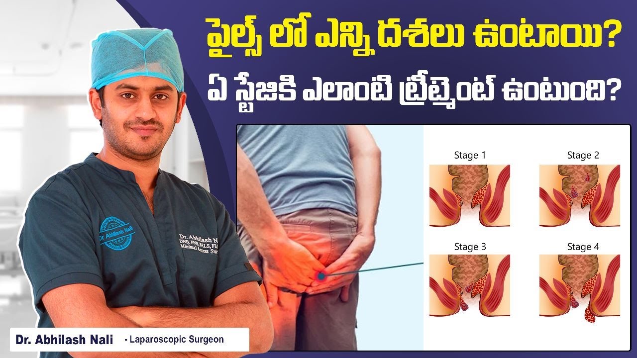 Best Treatment For Piles In Telugu best-treatment-for-piles-in-telugu