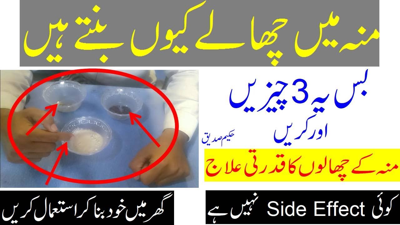 moun (mouth) ke chale چھالے ka ilaj in urdu | munh kay chalay | moun ke ...