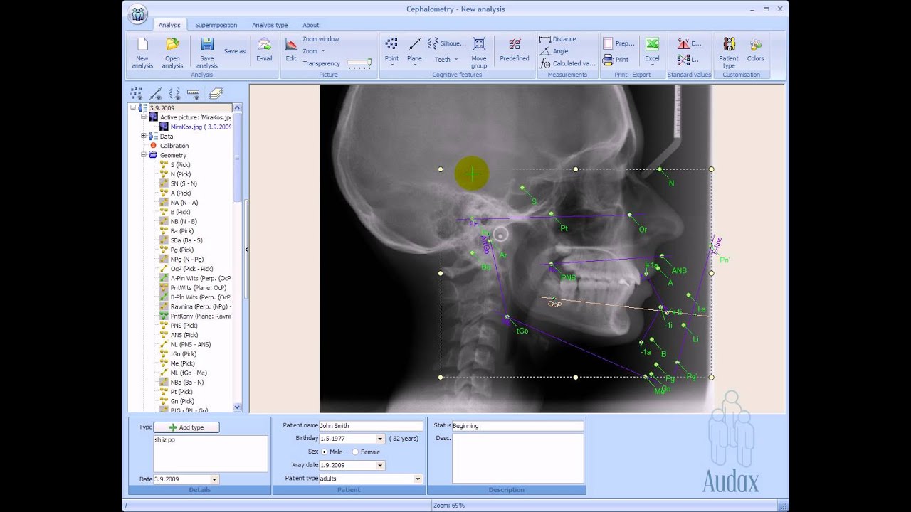 Ax.CEPH Cephalometric Analysis - YouTube