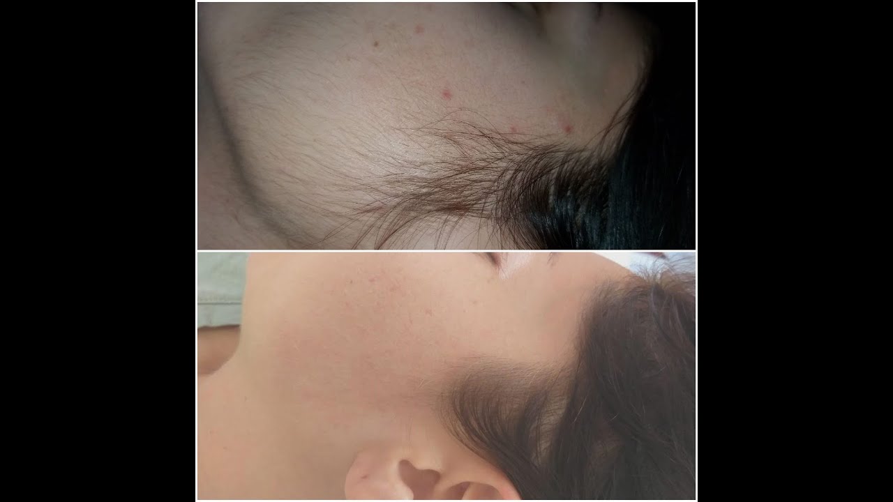 Epilare definitivă prin electroliză perciuni - ENA COSMETICS SALON ...