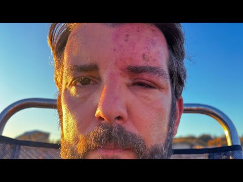 Sobrevivir al HERPES ZOSTER 😅 Consejos para aliviar el dolor