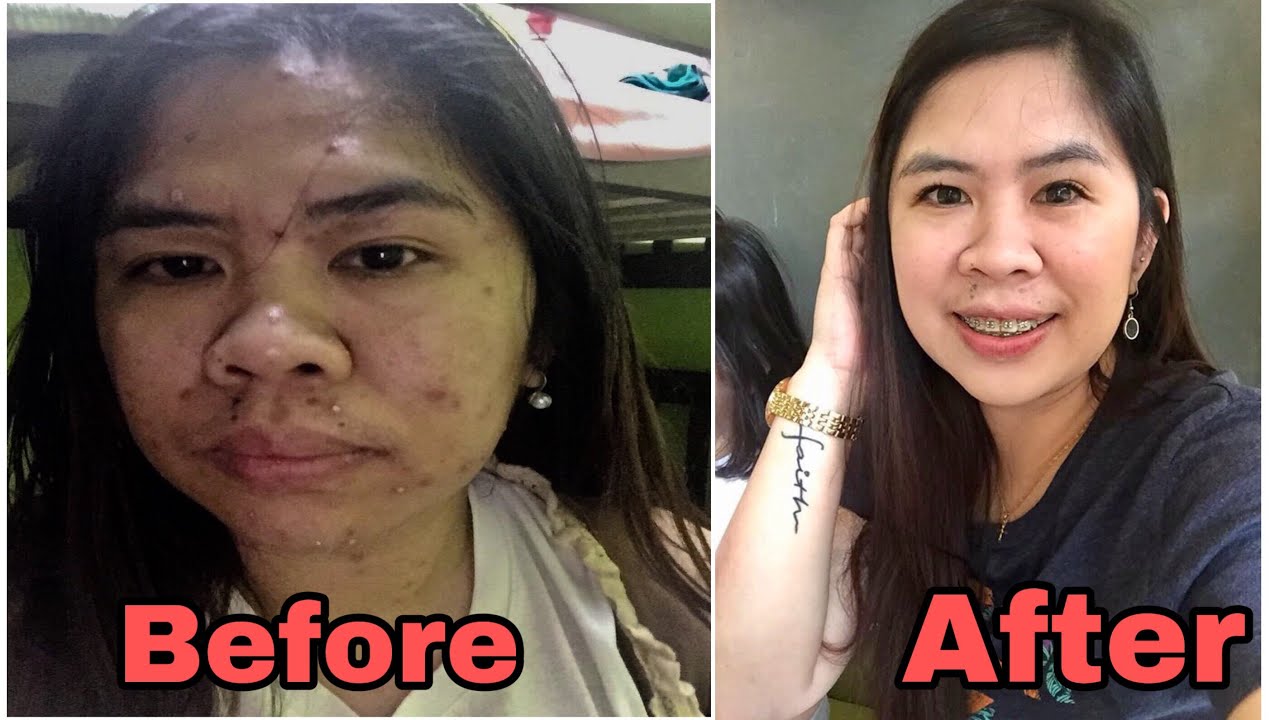 How to remove chicken pox scars? Paano nawala chicken pox scars ko sa ...