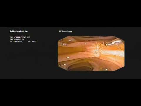 Cewnikowanie - YouTube