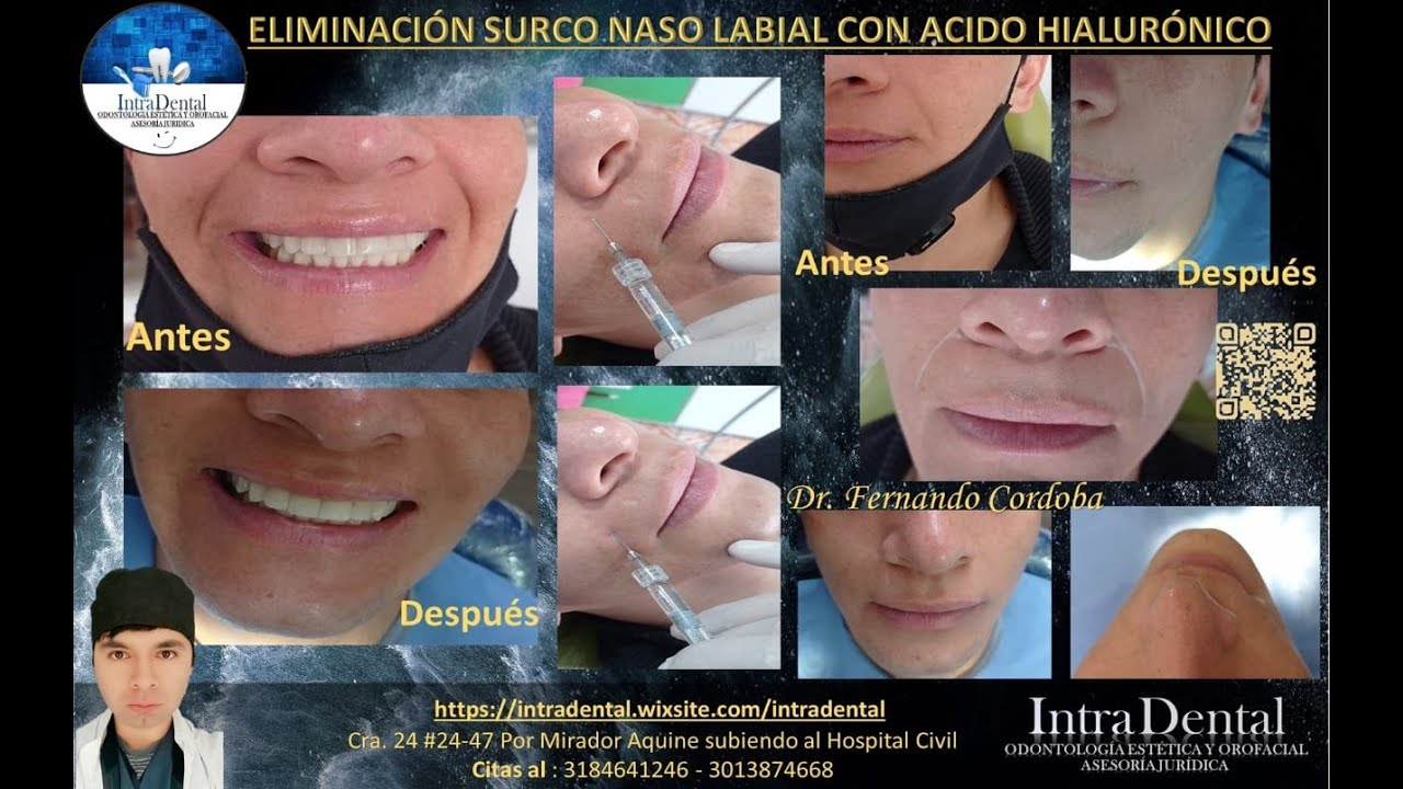 Eliminación surco naso labial con acido hialurónico - YouTube