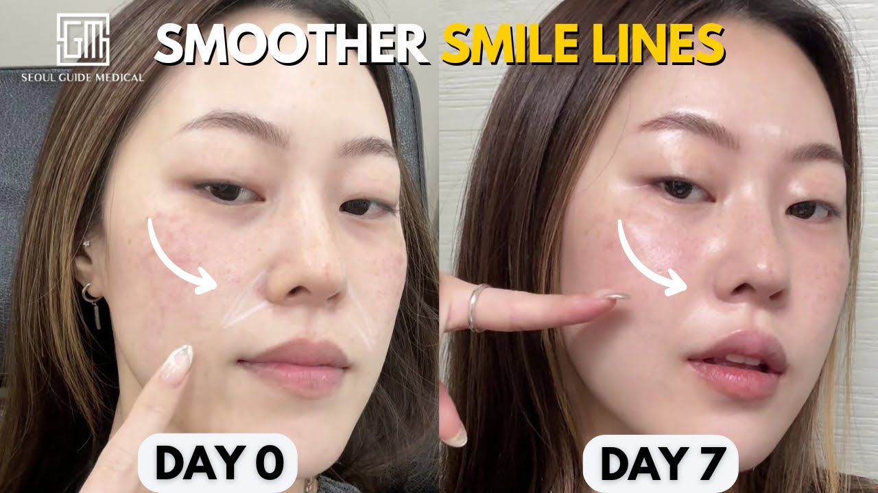 How I Got Rid of My Smile Lines with NO Surgery | Ultracol + Clear ...