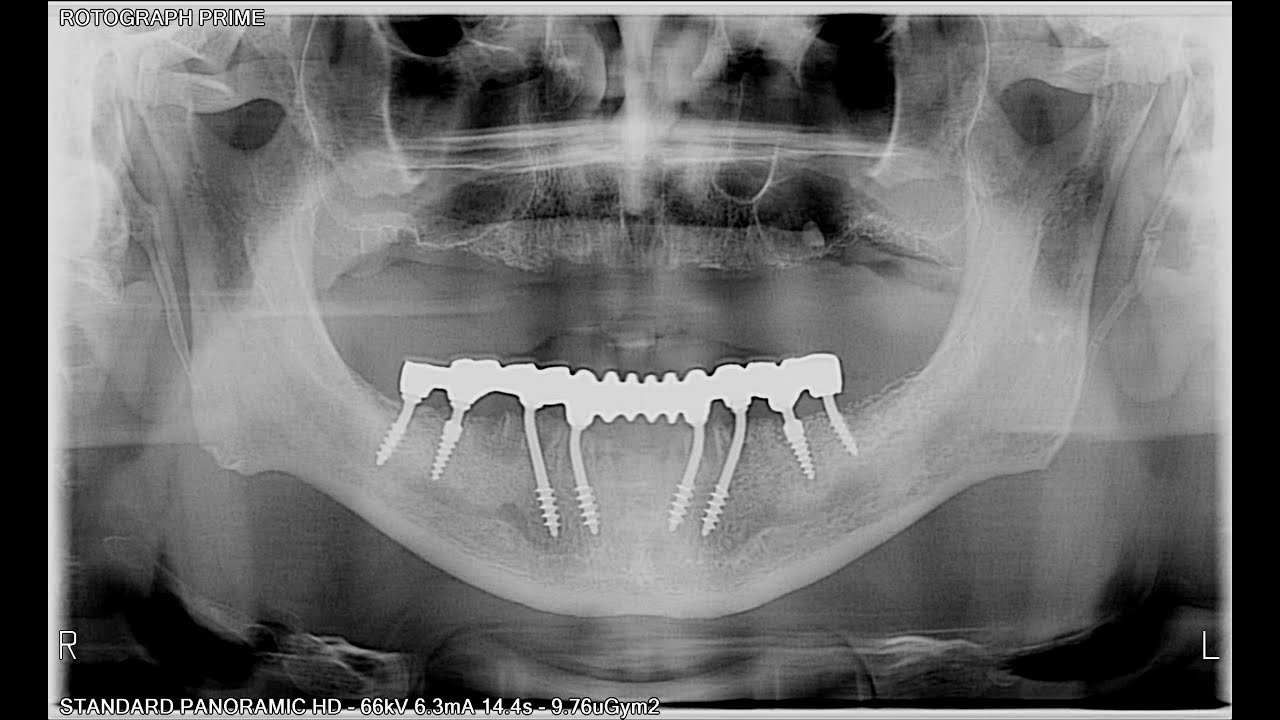 How to place Basal Implants (Teeth in 72 Hours) - YouTube