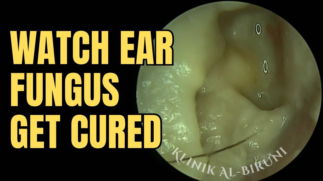 Watch Ear Fungus Get Cured - YouTube