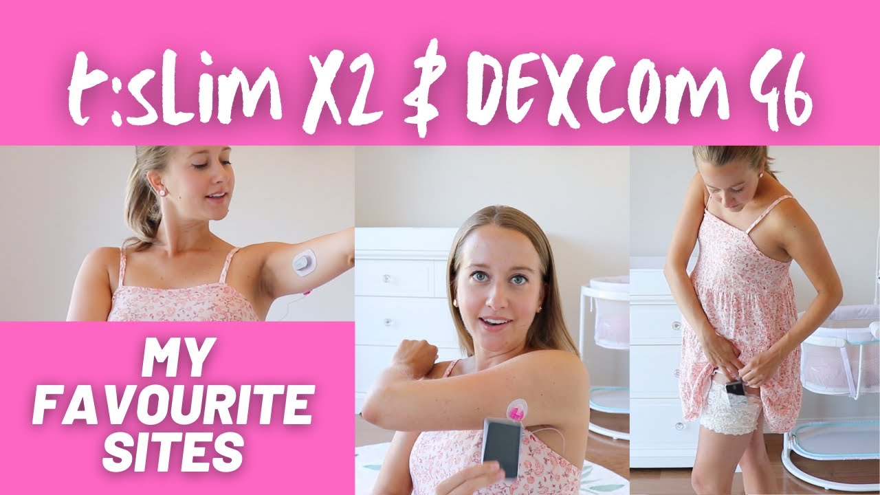 my favourite t:slim X2 insulin pump and Dexcom G6 sites during ...
