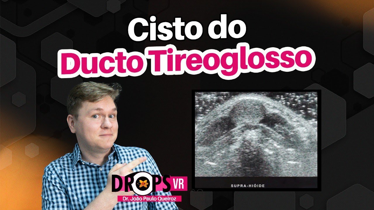 Anatomia Do Cisto Do Ducto Tireoglosso