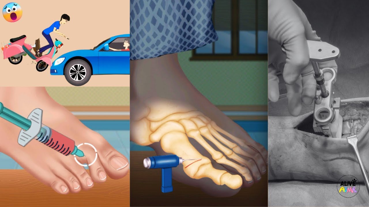 ASMR Treatment Feet Accident | Foot care animation | ASMR Traitement ...