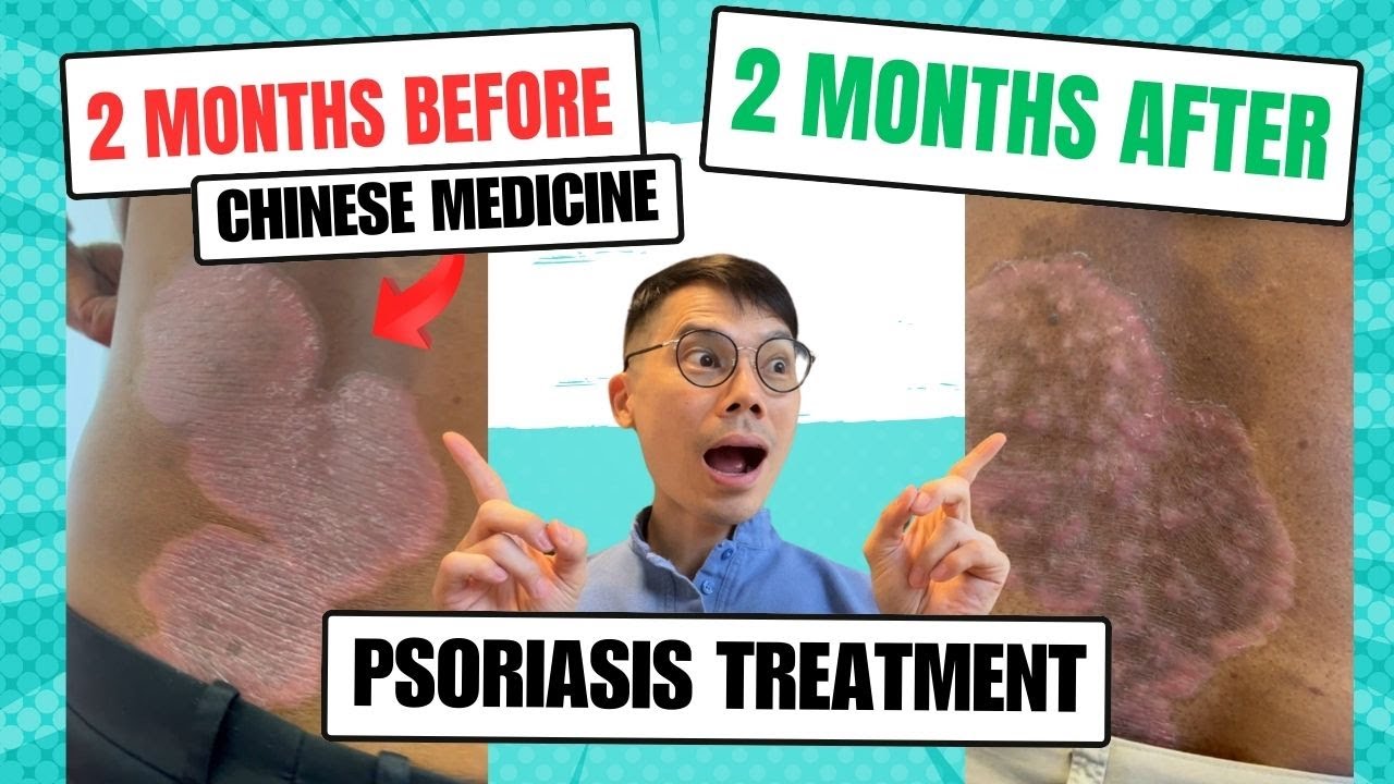 Psoriasis Treatment with Chinese Medicine (2 Months Outcome) # ...