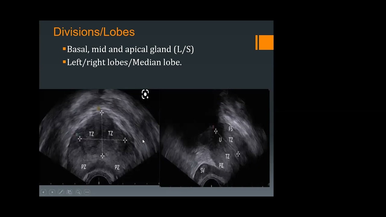 Key aspects of Prostate Ultrasound - YouTube