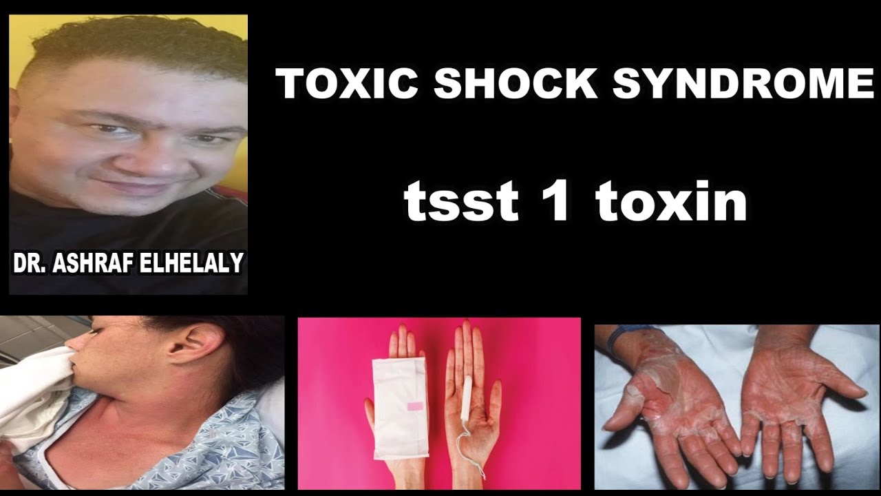 3- Bacteriology | staphylococcal toxic shock syndrome | pathology ...