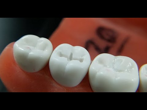 Class I Prep with Amalgam Filling on Tooth #31 - YouTube