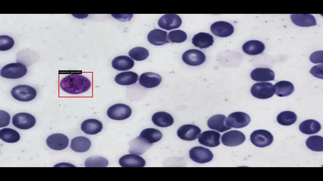 Malaria detection AI model created using Vredefort. - YouTube