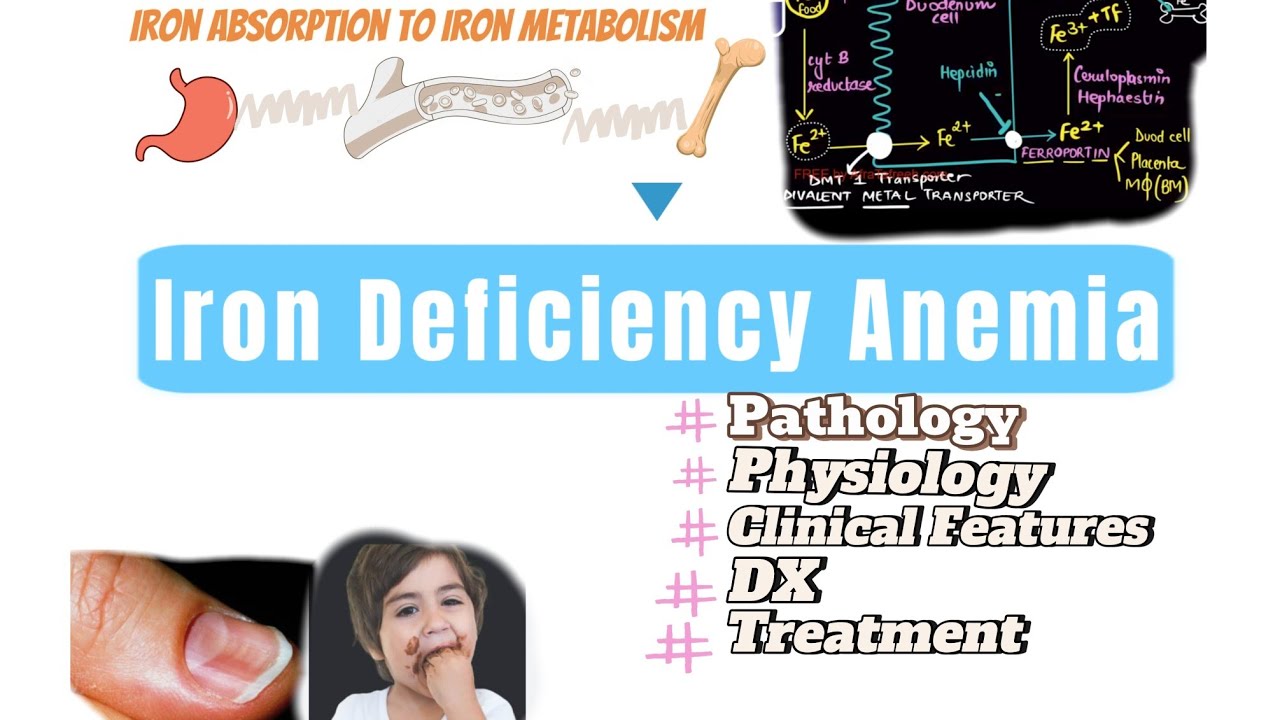 Iron Deficiency Anemia Briefly Explained| USMLE| Important mcqs #usmle ...