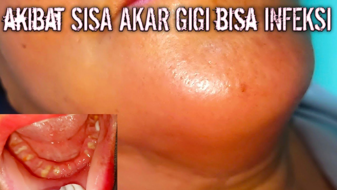 Jangan Sepelekan Sisa Akar Gigi Meski Kecil Kalau Tidak Ingin Seperti Ini - YouTube