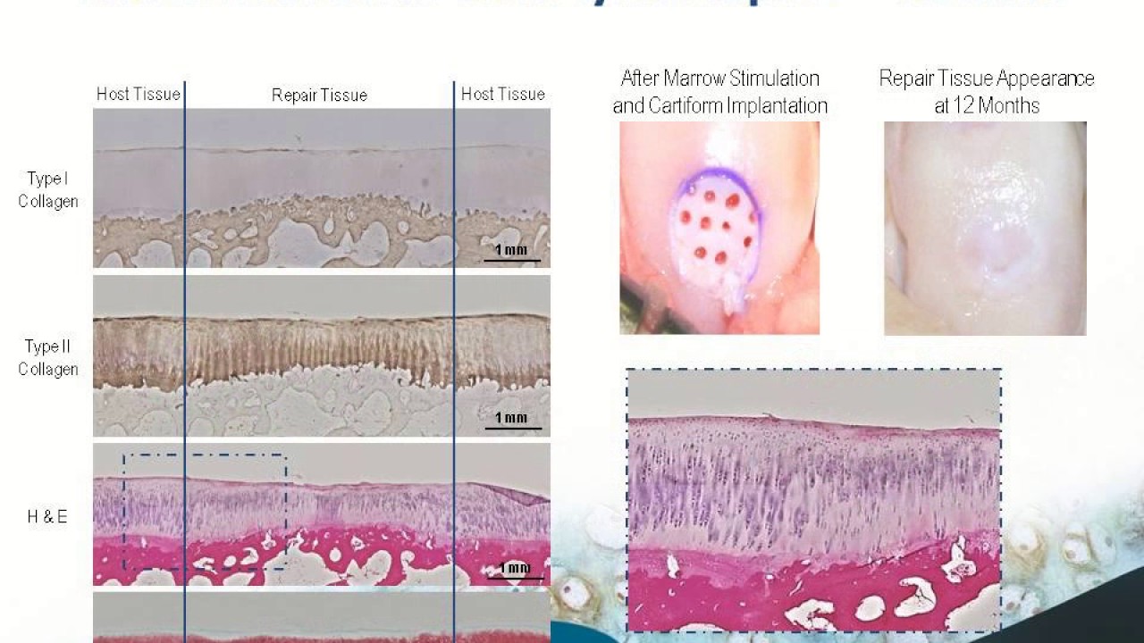 Biologic Algorithm Articular Cartilage Restoration - Dr. Thomas Matelic ...