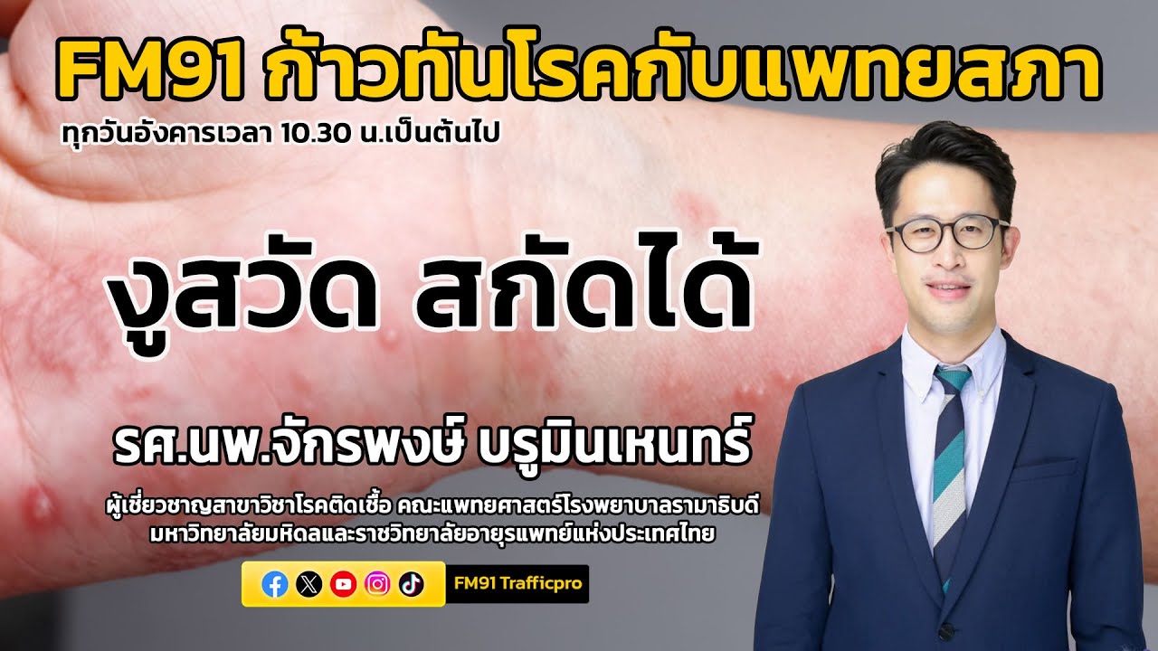 งูสวัด สกัดได้ : FM91 ก้าวทันโรคกับแพทยสภา : 16 กรกฎาคม 2567 - YouTube