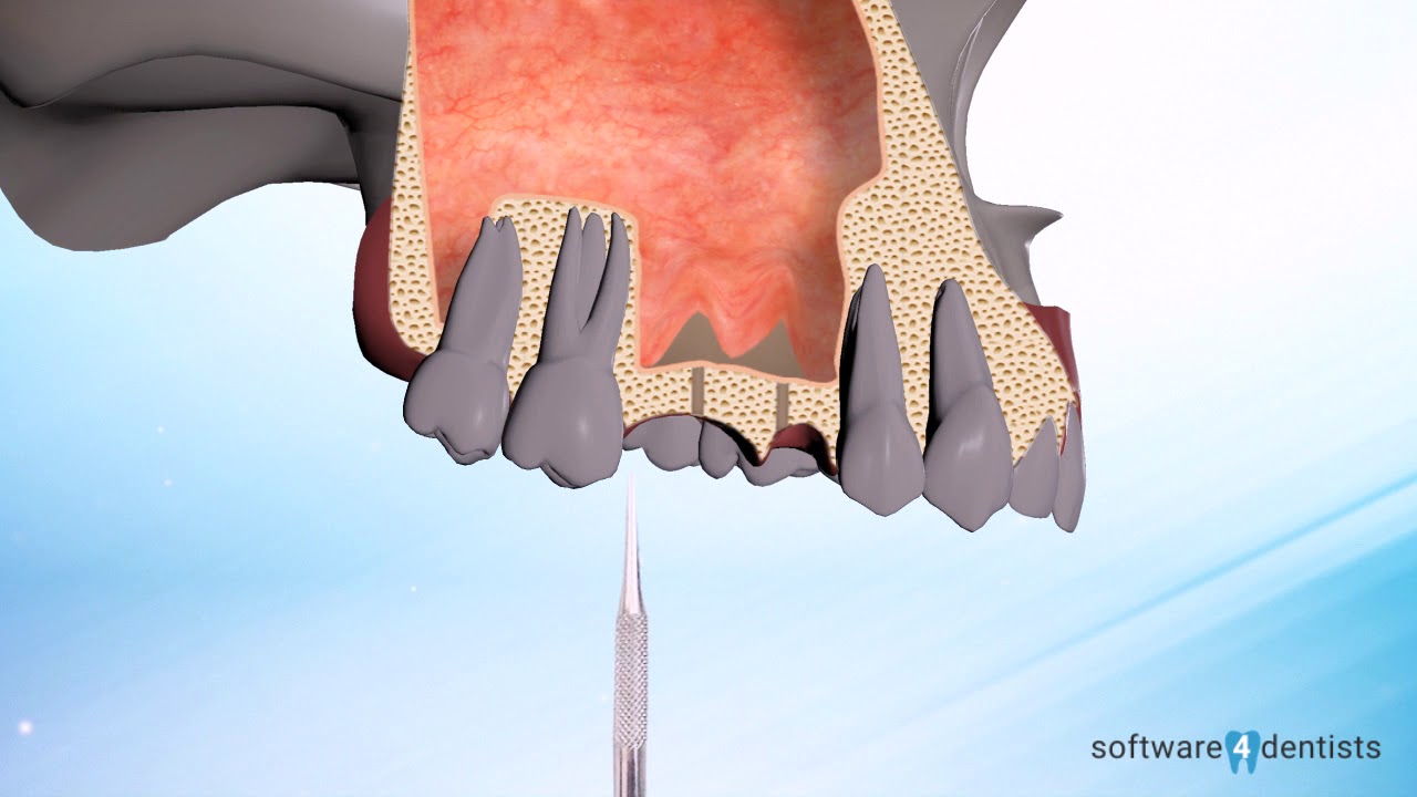Sinus Lift animation - YouTube