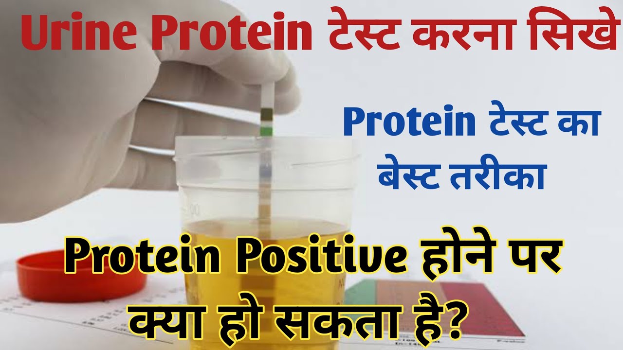 urine protein test | sulfosalicylic acid test - YouTube
