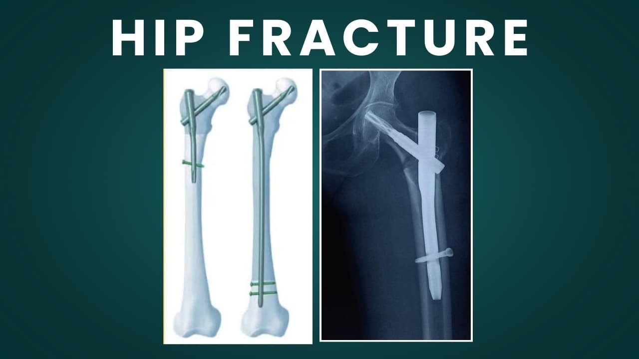 HIP FRACTURE IN AN 85/F. CRIF WITH MEDTRONIC PFN DONE AND MOBILISED ...