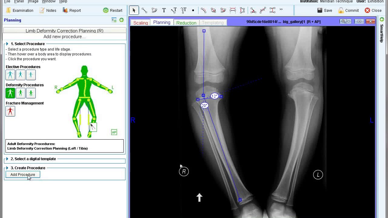 Other Deformity Wizards | Deformity Correction Planning | Materialise ...