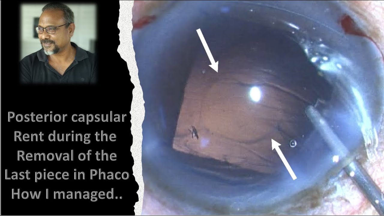 Posterior capsular rent while removing the last piece during Phaco and ...