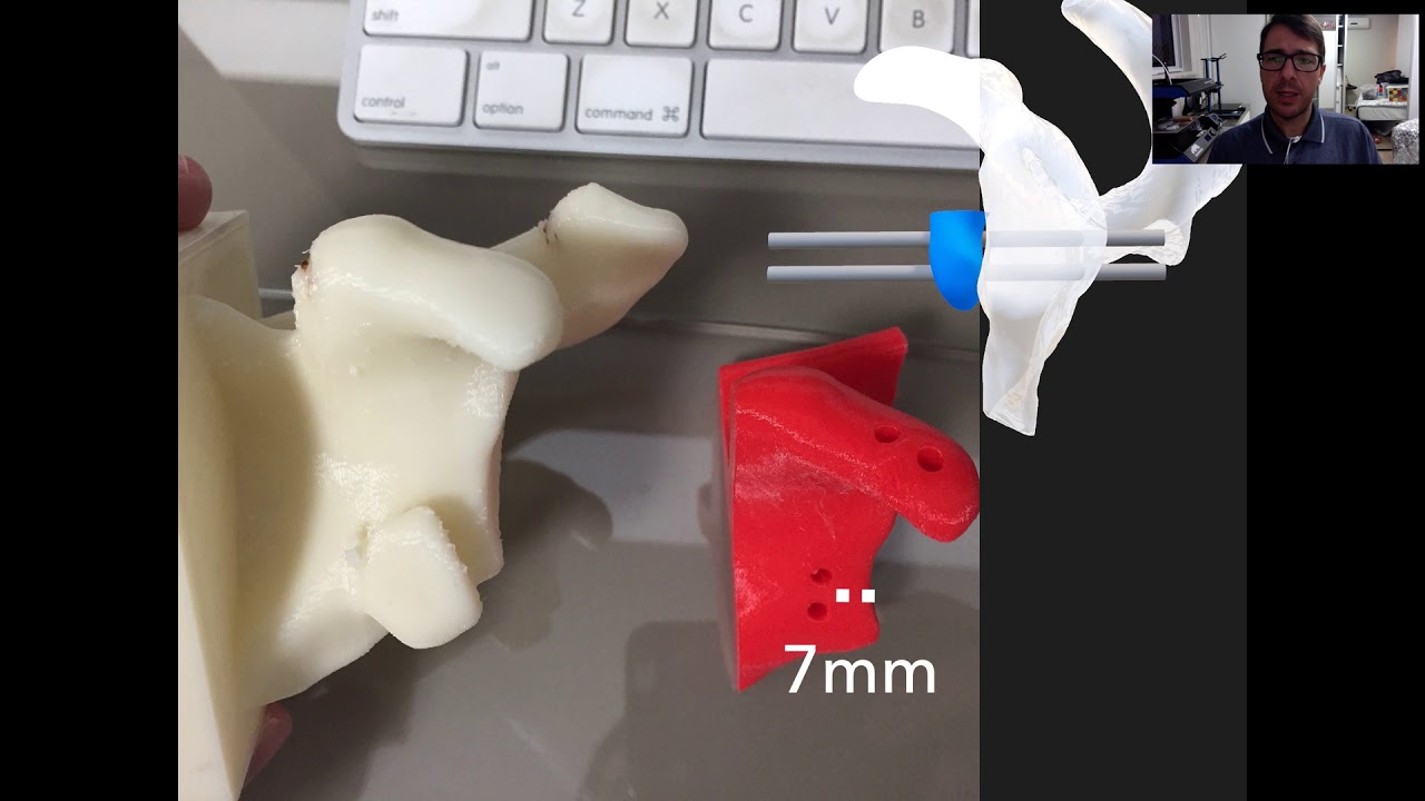 3D Printing and Virtual Reality for shoulder surgery 2019 - YouTube