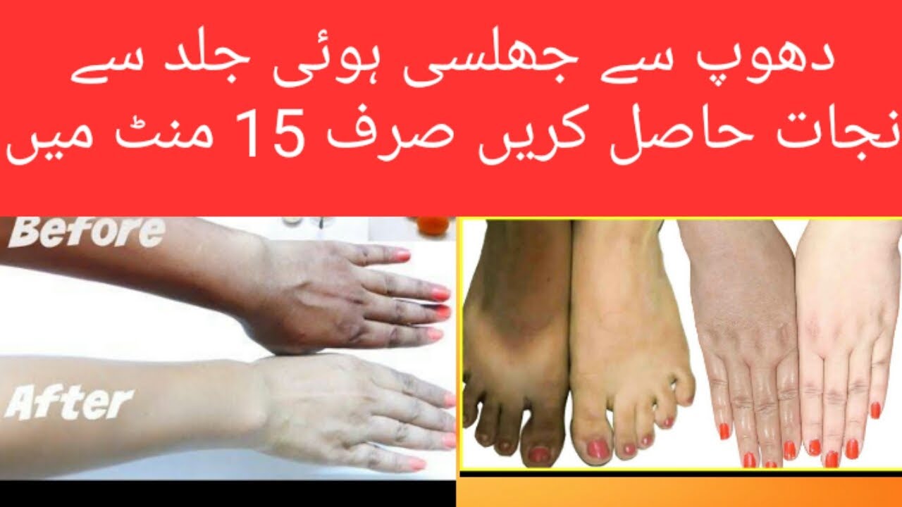 How to remove sun tan/Sun burn at home||Uneven skin tone - YouTube
